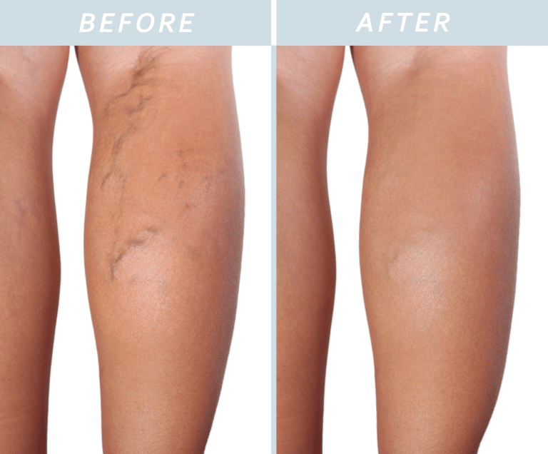 Learn About Sclerotherapy and its Benefits | Laser Lipo and Vein Center