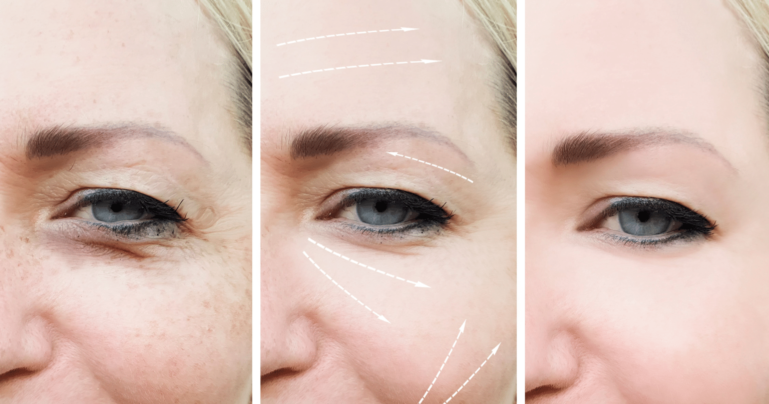 Fat Grafting for Facial Rejuvenation | Laser Lipo and Veins