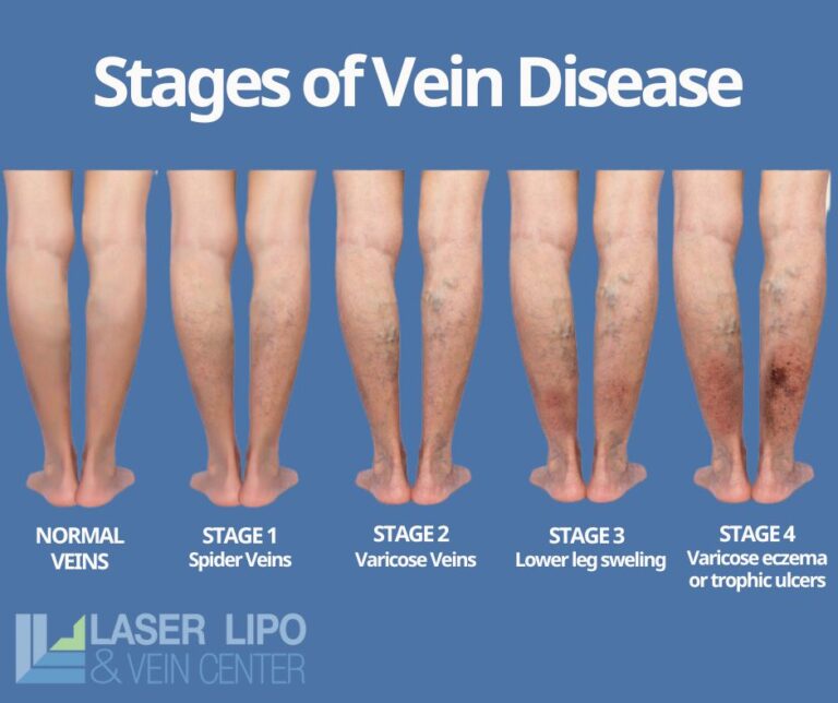 Understanding the Importance of Vein Health | Laser Lipo and Veins