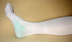 Compression Stockings for Lipedema | Laser Lipo and Veins