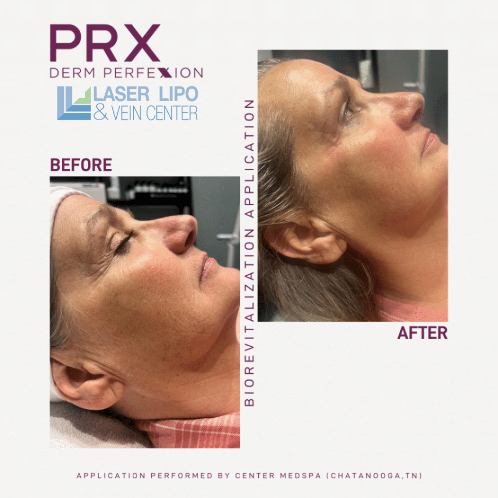 Discover Youthful Radiance with PRX Skin Biostimulation - Laser Lipo
