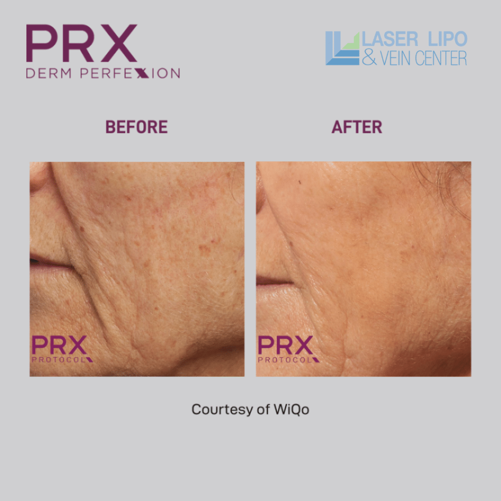 Discover Youthful Radiance with PRX Skin Biostimulation - Laser Lipo