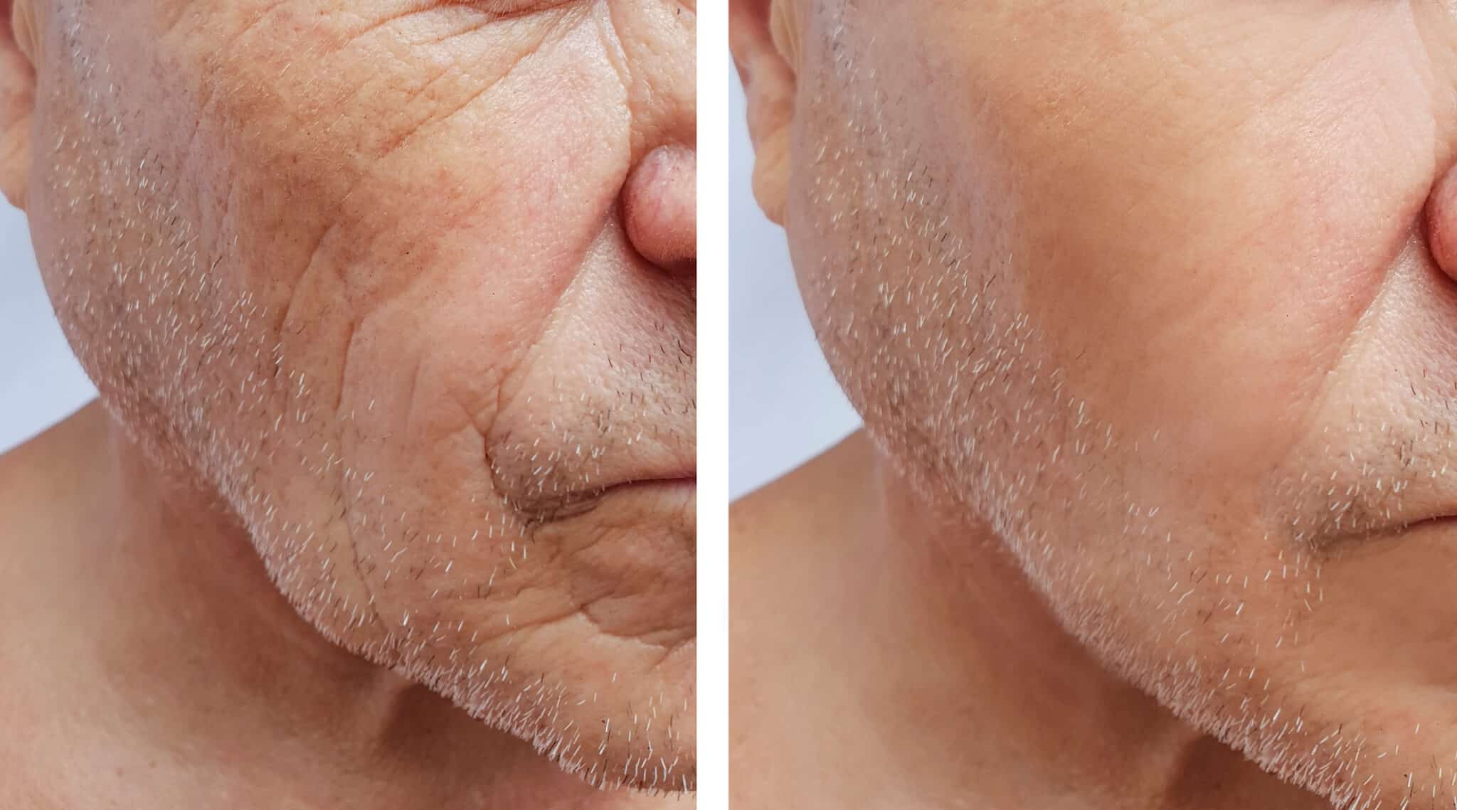 Get Rid of Wrinkles with Voluma Dermal Fillers | St. Louis Wrinkle ...