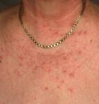 Treat Spider and Varicose Veins on Chest / Trunk in St. Louis | Laser ...