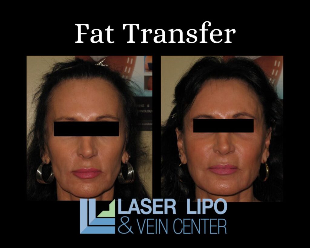 Fat Transfer St Louis Procedures | St Louis Laser Lipo and Veins