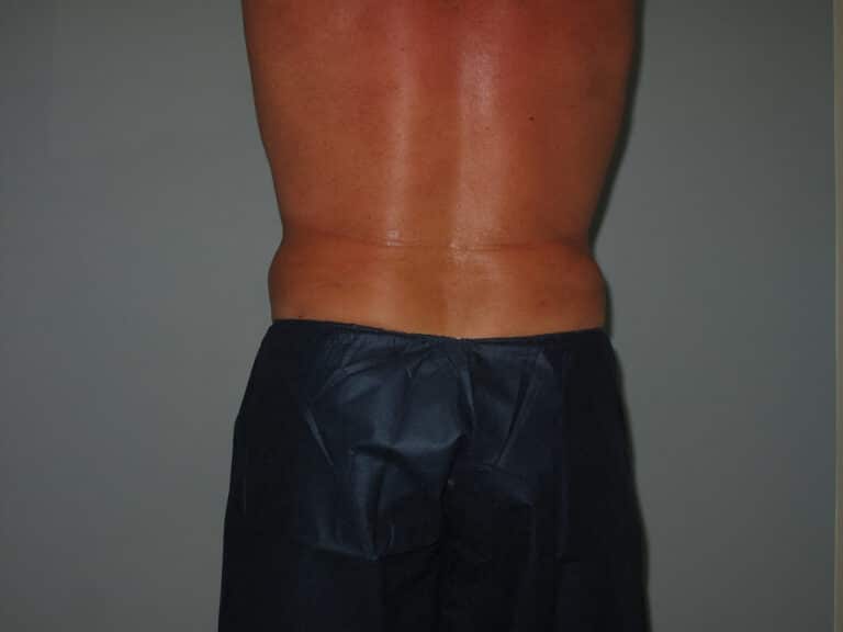 Upper, Lower, and Full Back Liposuction | St Louis | Laser Lipo and ...