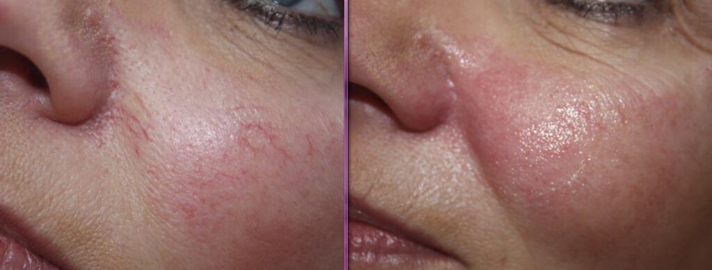 Spider Vein Treatment in St. Louis | Laser Lipo and Veins