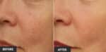 Veinwave Vein Treatment in St Louis | Laser Lipo and Veins